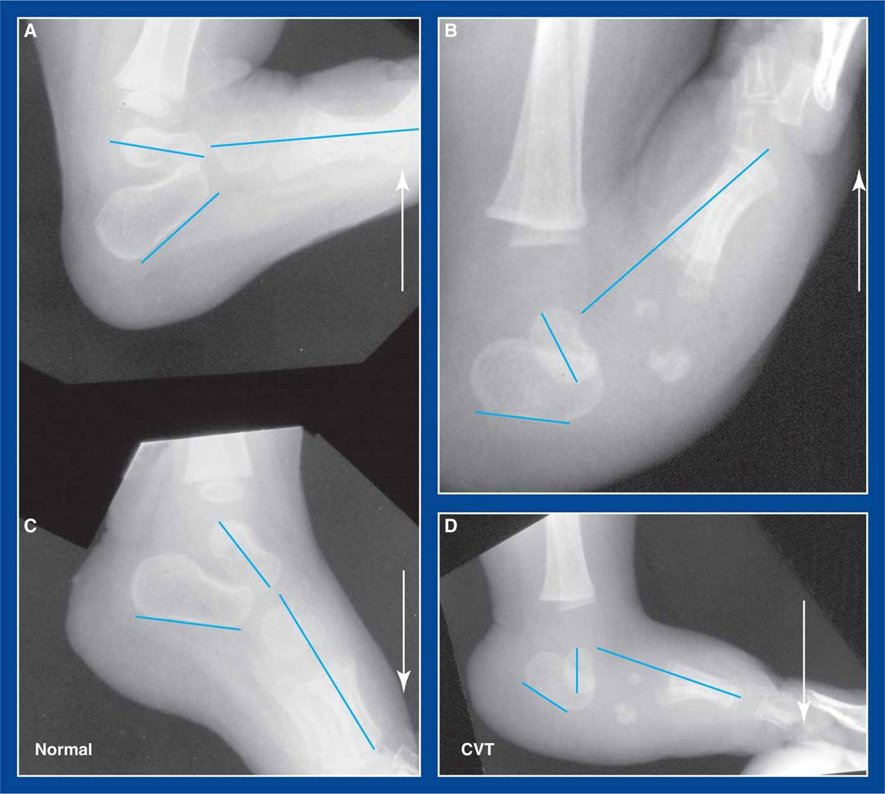 CONGENITAL VERTICAL/OBLIQUE TALUS - FOOT AND ANKLE DEFORMITIES ...