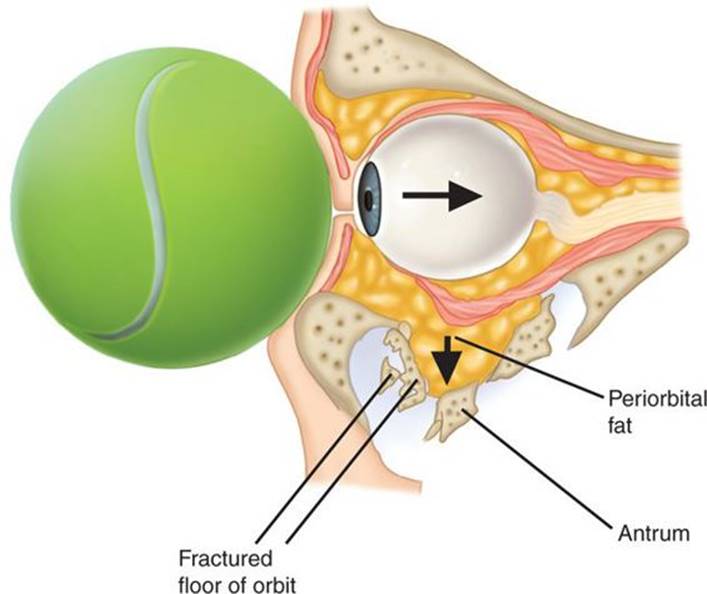 Maxillofacial Trauma - Strange and Schafermeyer's Pediatric Emergency ...