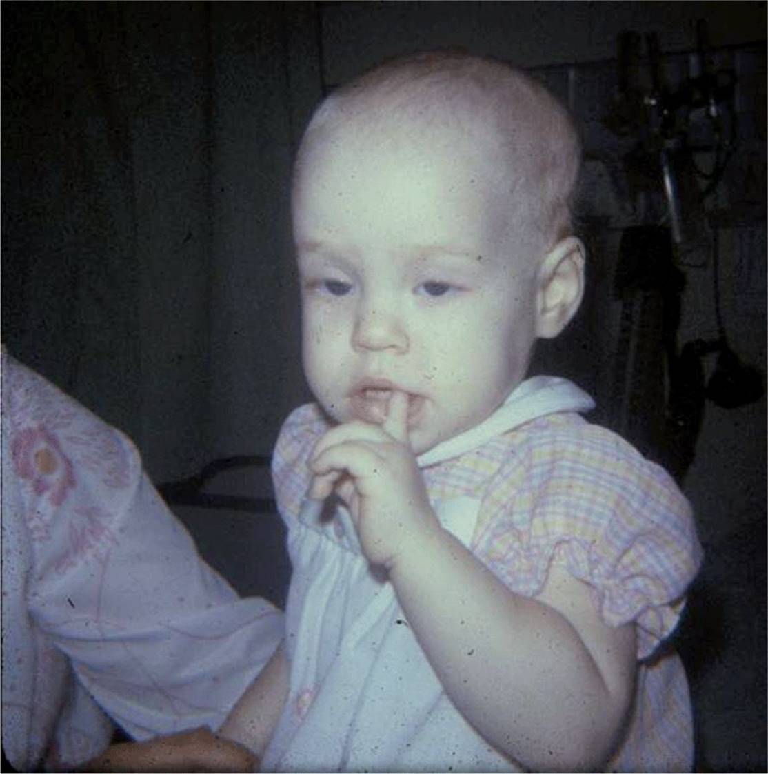 Twelve-Month-Old Girl - PALLOR - Symptom-Based Diagnosis in Pediatrics ...