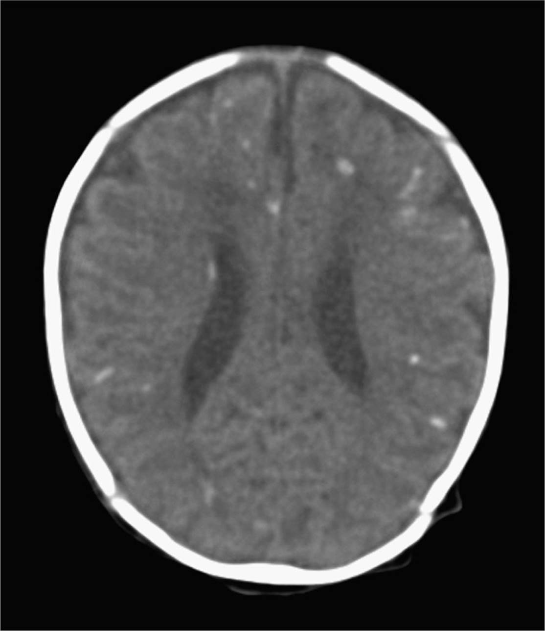 Eight-Day-Old Girl - SEIZURES - Symptom-Based Diagnosis in Pediatrics ...