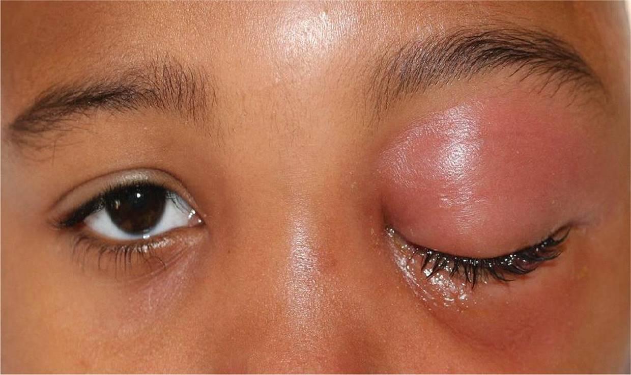 Swelling of/Around the Eye - Visual Diagnosis and Treatment in ...
