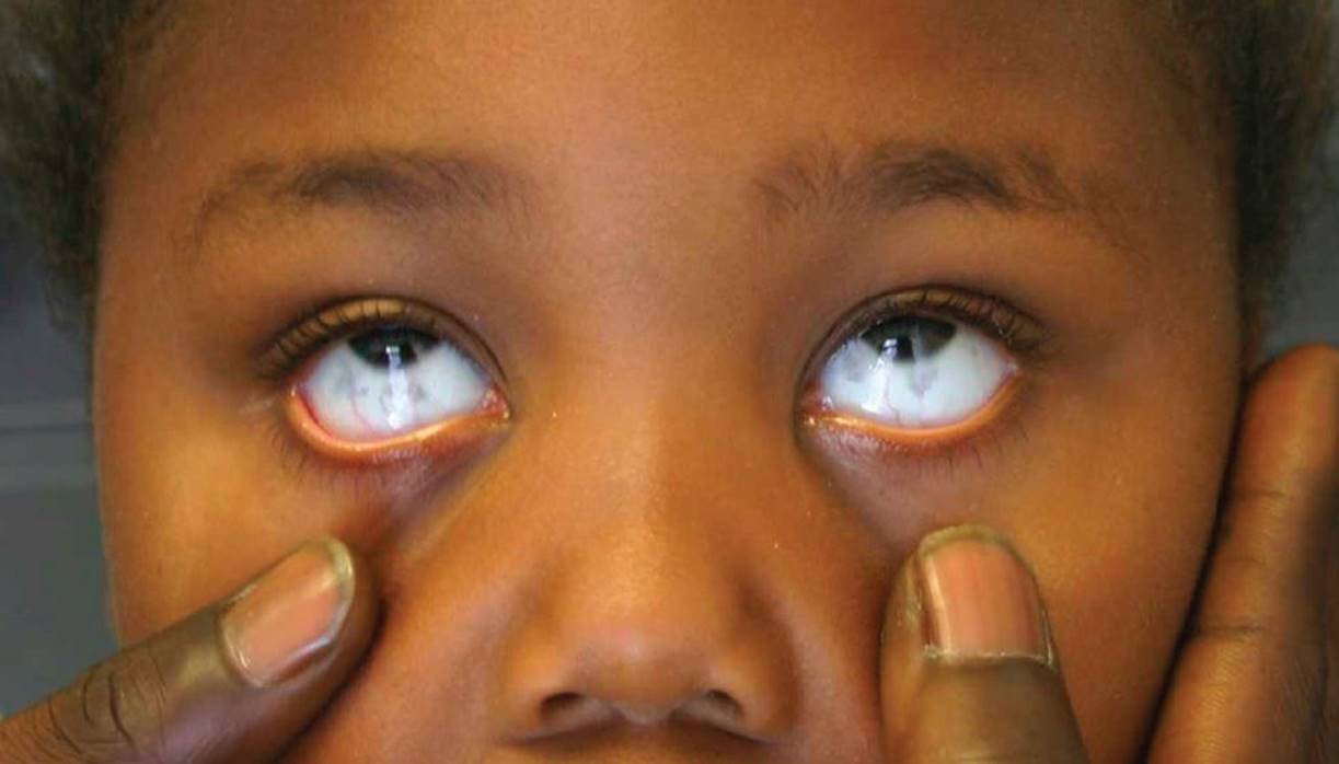 Discoloration of/Around the Eye - Visual Diagnosis and Treatment in ...