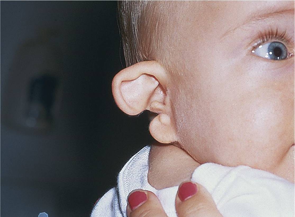 Abnormalities in Ear Shape and Position - Visual Diagnosis and ...