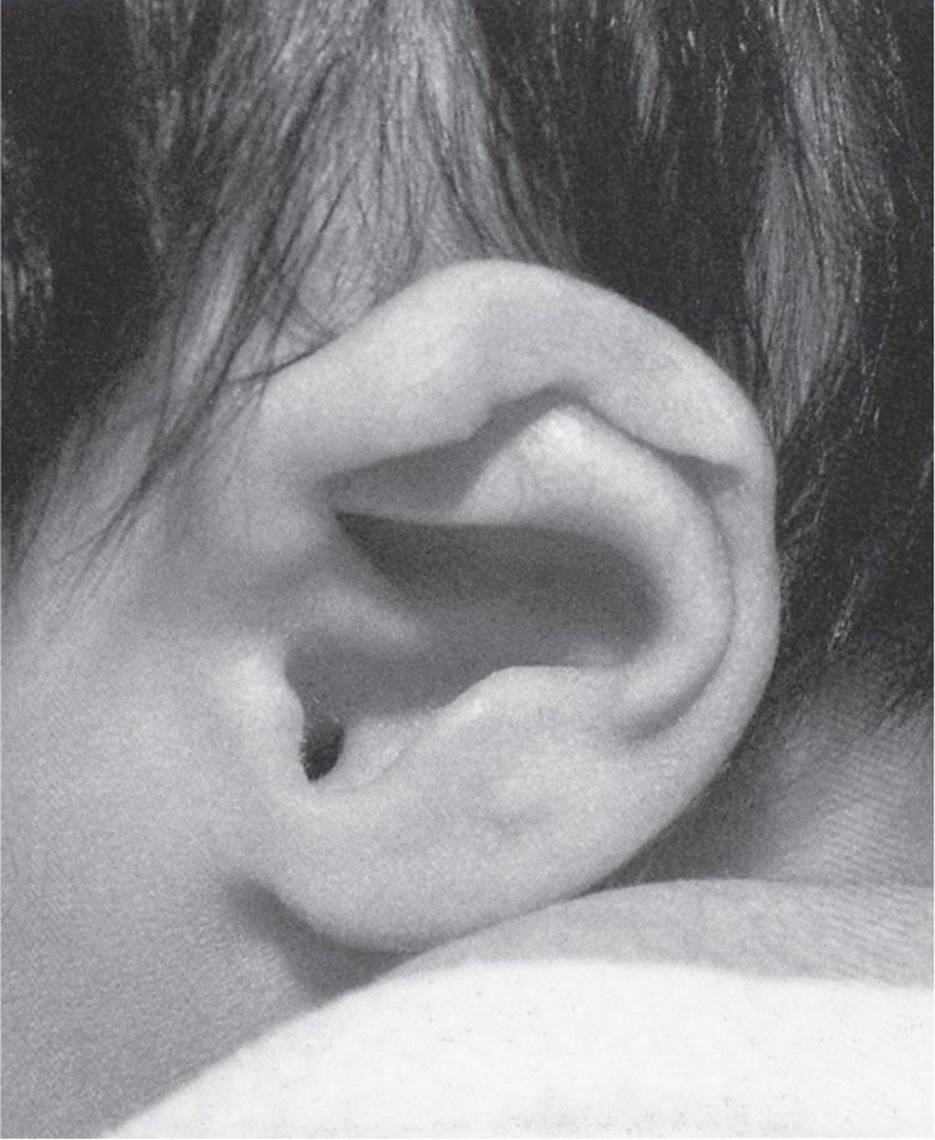 Abnormalities in Ear Shape and Position - Visual Diagnosis and ...