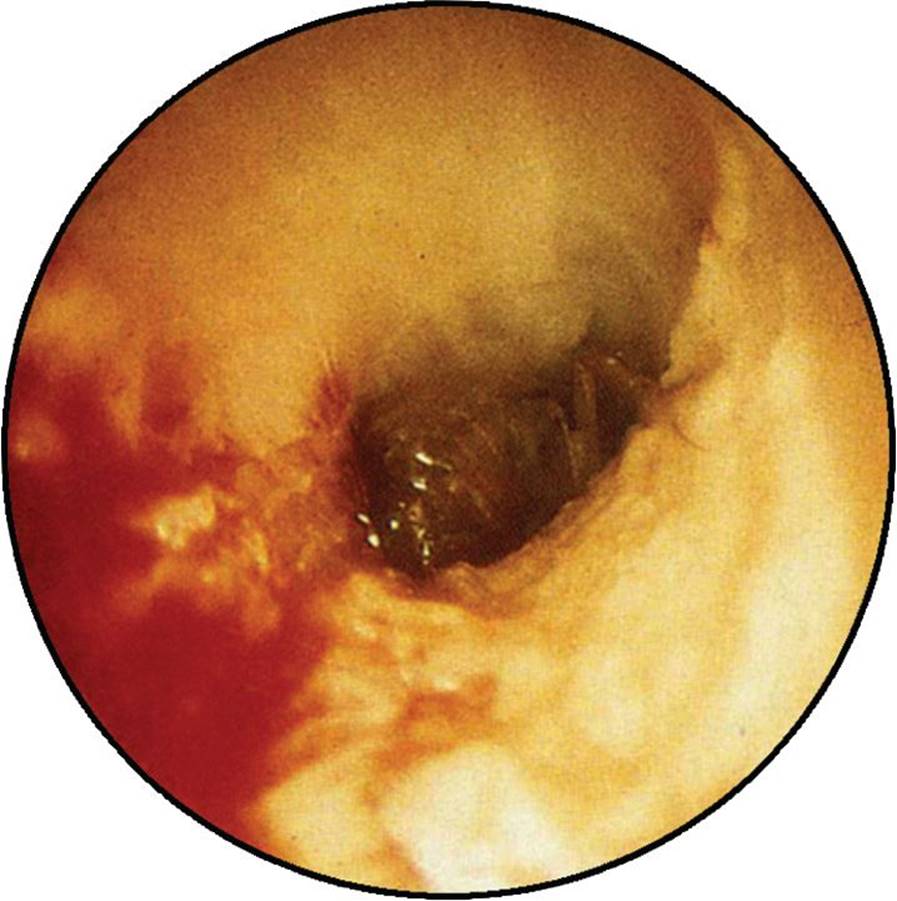 Ear Canal Findings - Visual Diagnosis and Treatment in Pediatrics, 3 Ed.