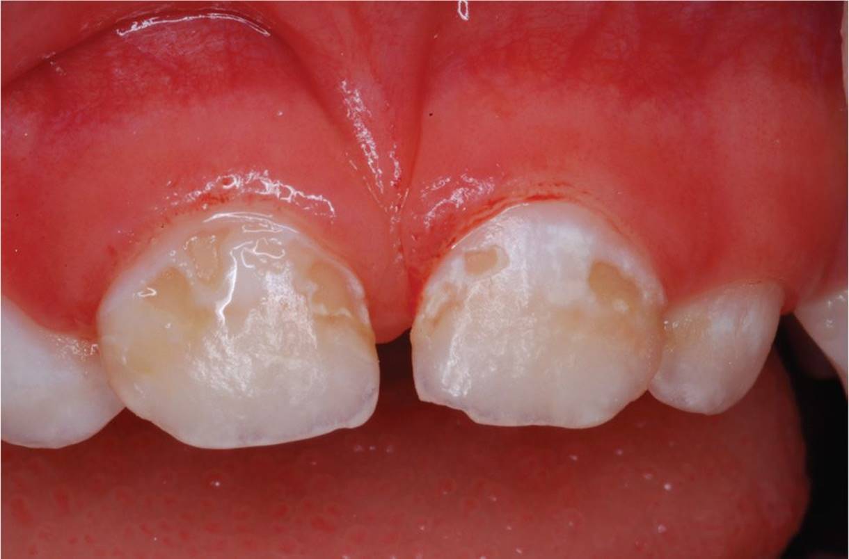 Discoloration of Teeth - Visual Diagnosis and Treatment in Pediatrics ...