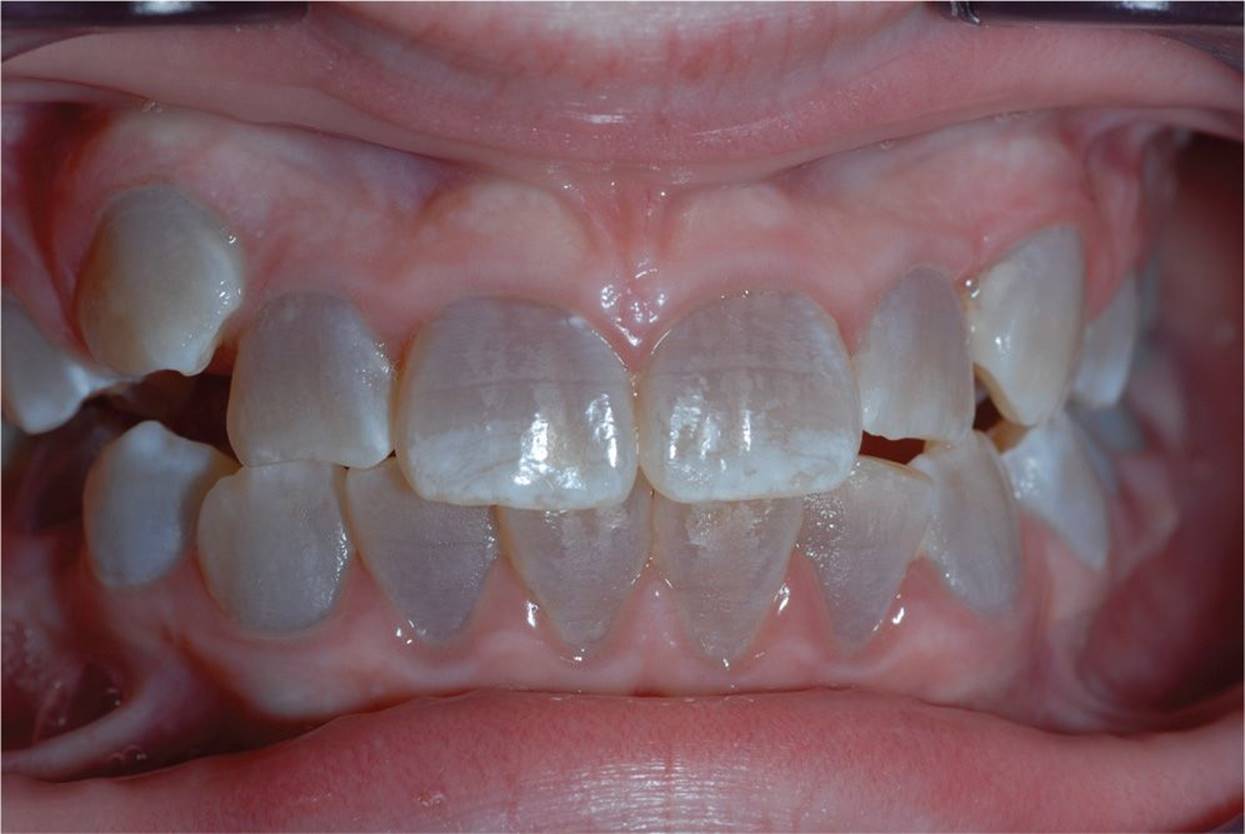 Discoloration of Teeth - Visual Diagnosis and Treatment in Pediatrics ...