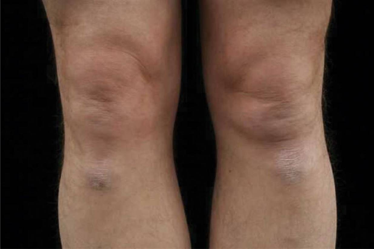 Knee Swelling - Visual Diagnosis and Treatment in Pediatrics, 3 Ed.