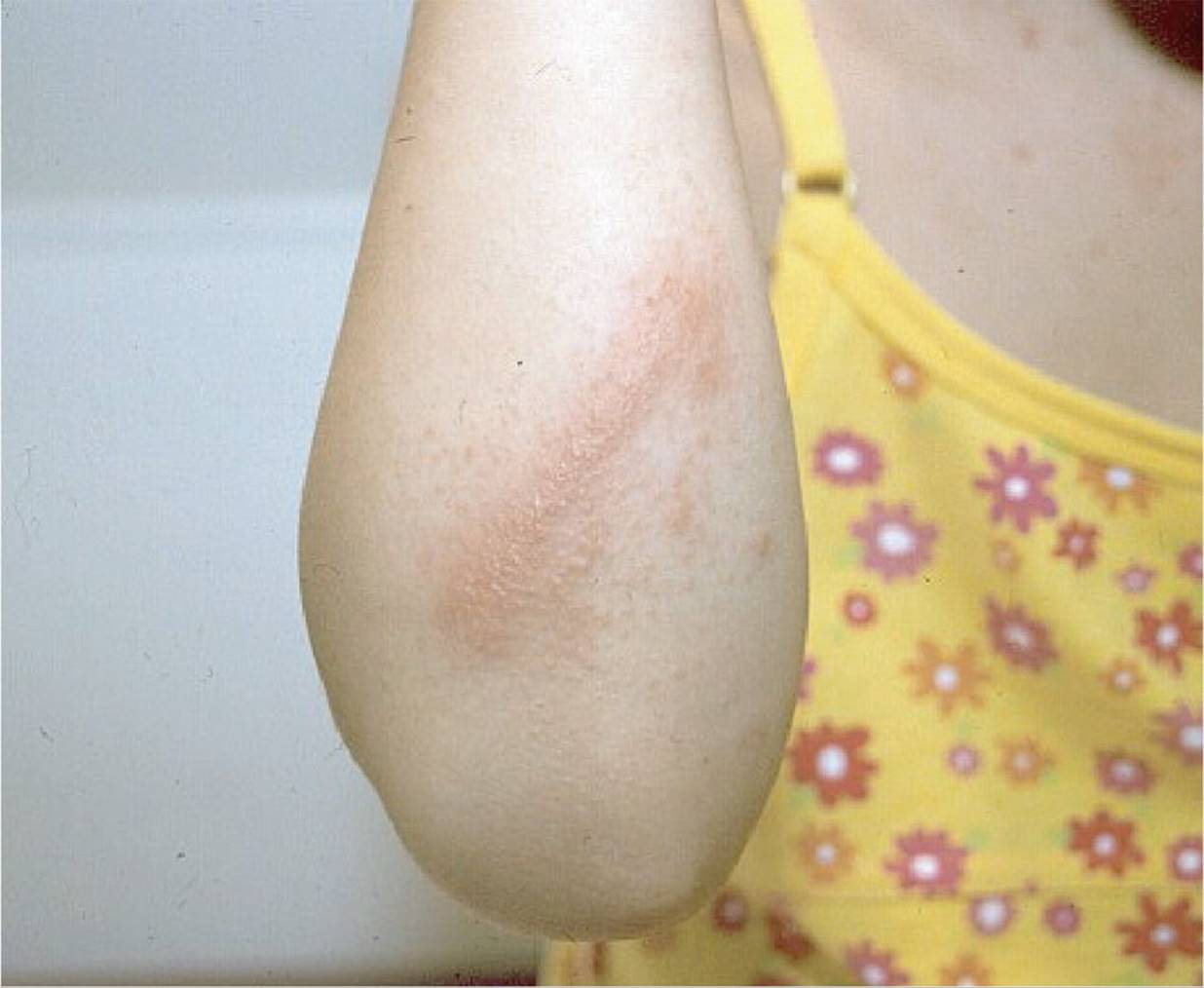 Linear Red Rashes - Visual Diagnosis and Treatment in Pediatrics, 3 Ed.