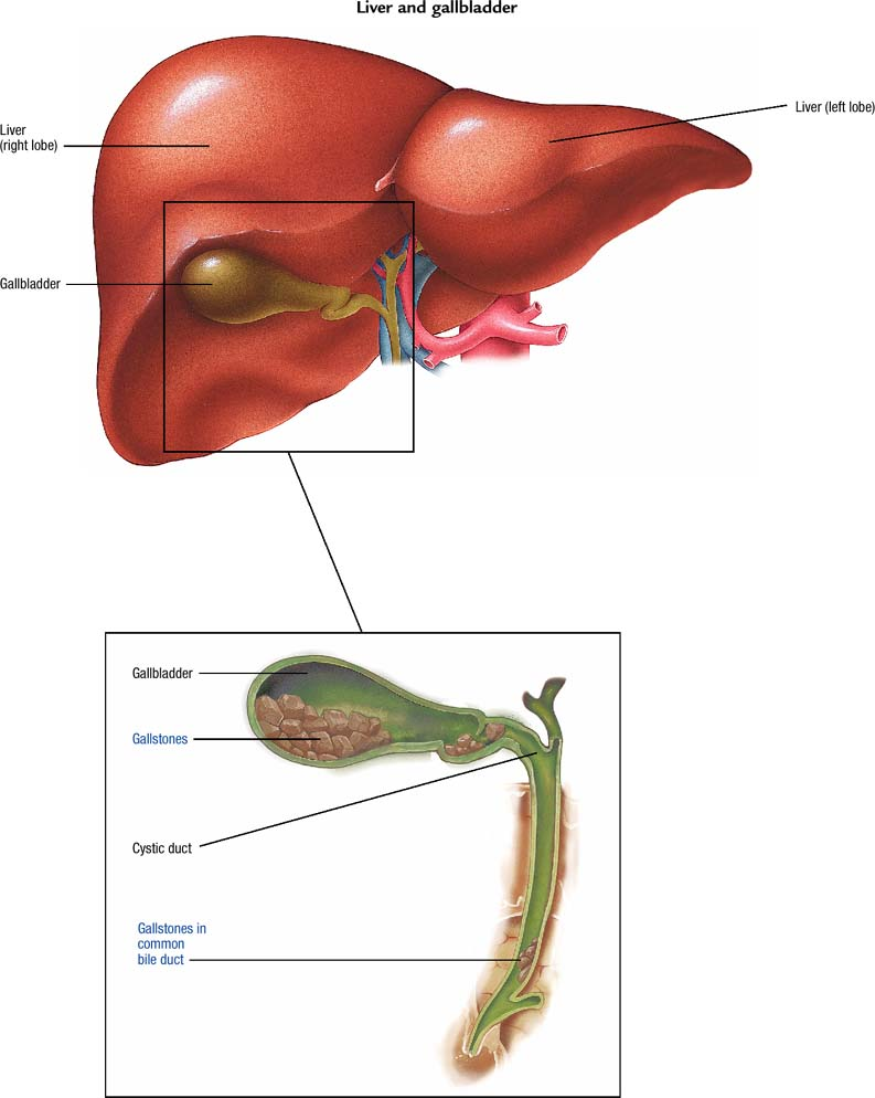 Cholecystitis - Atlas of pathophysiology, 2 Edition