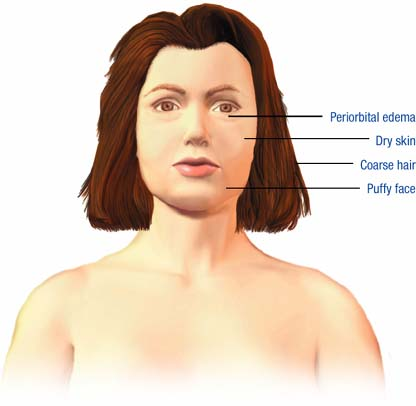 Hypothyroidism - Atlas of pathophysiology, 2 Edition