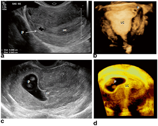 Interstitial Pregnancy - Ectopic Pregnancy: A Clinical Casebook