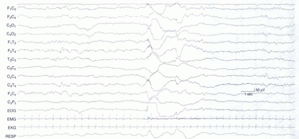 Artifacts - Atlas of Neonatal Electroencephalography
