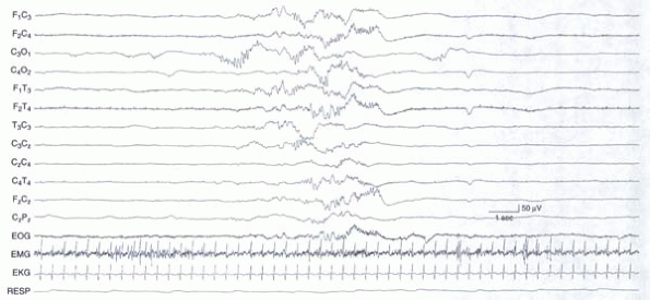 Electroencephalographic Abnormalities of Premature and Term Neonates ...