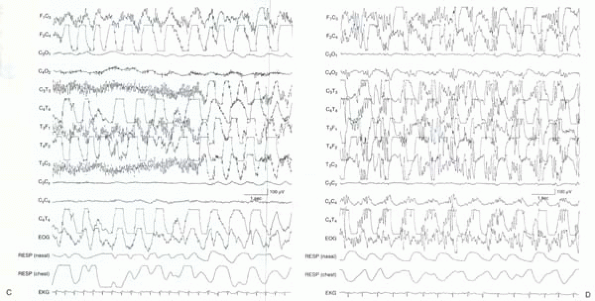 Electroencephalographic Abnormalities of Premature and Term Neonates ...