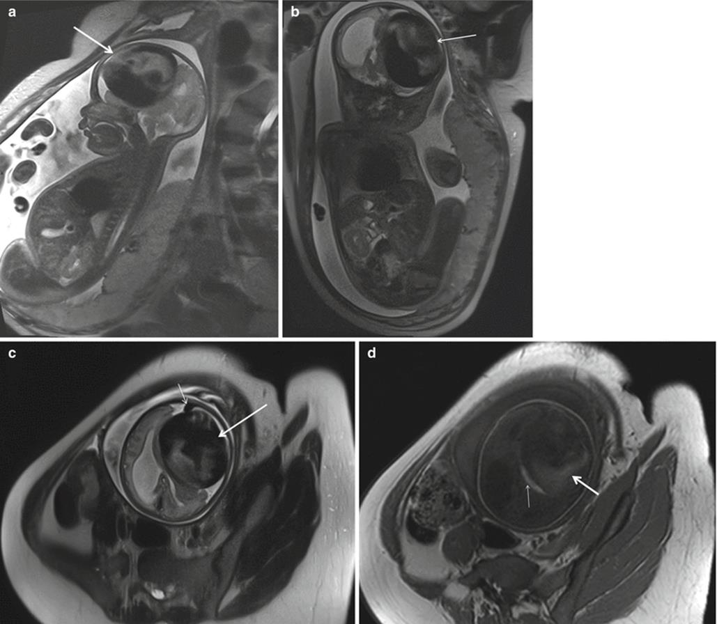 Clinical Indications to MRI in Pregnancy - MRI of Fetal and Maternal ...