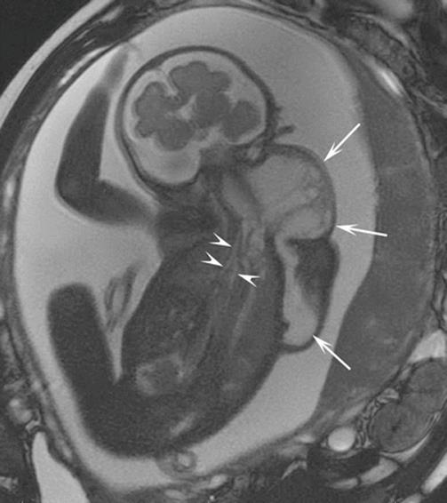 Fetal MR Imaging: Protocols and Anatomy - MRI of Fetal and Maternal ...