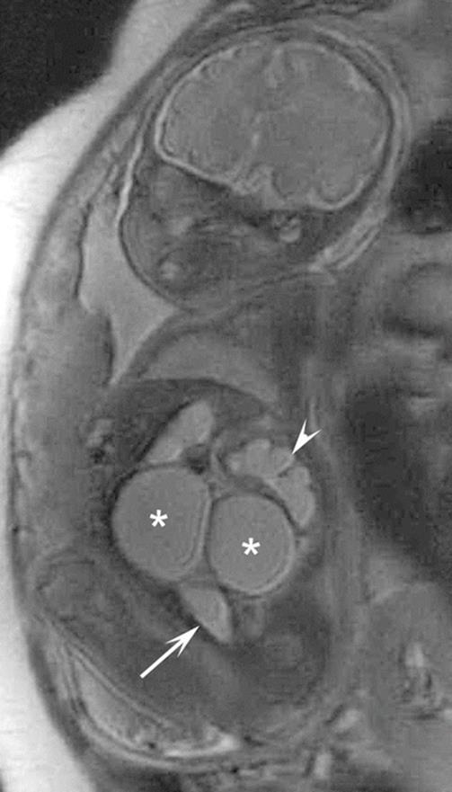 Fetal MR Imaging: Protocols and Anatomy - MRI of Fetal and Maternal ...