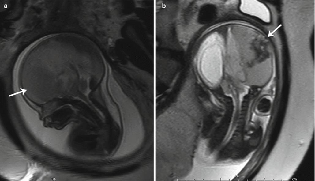 MRI of the Fetal Head and Neck - MRI of Fetal and Maternal Diseases in ...