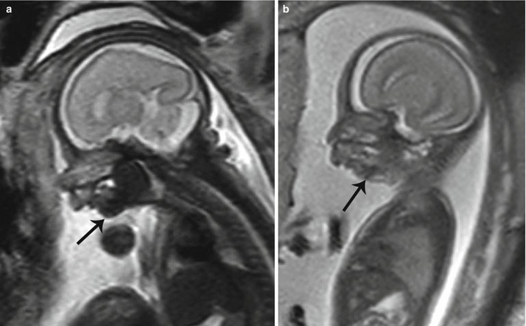 MRI of the Fetal Head and Neck - MRI of Fetal and Maternal Diseases in ...