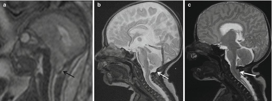 MRI of Fetal Spine and Extremities - MRI of Fetal and Maternal Diseases ...