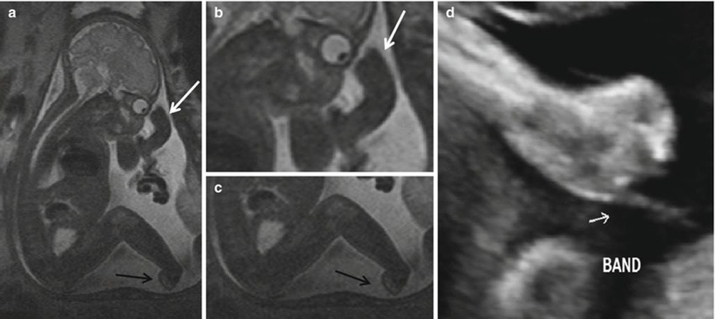 MRI of Fetal Spine and Extremities - MRI of Fetal and Maternal Diseases ...