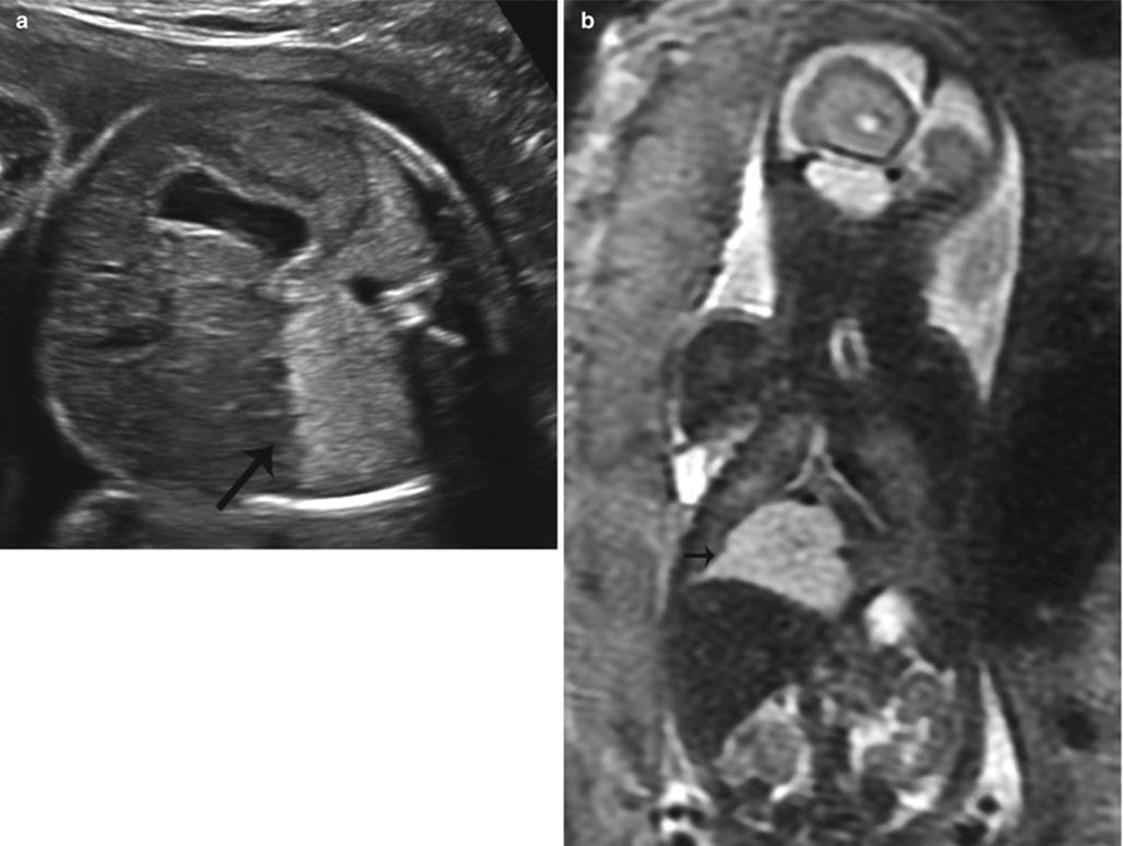MRI of the Fetal Chest - MRI of Fetal and Maternal Diseases in ...