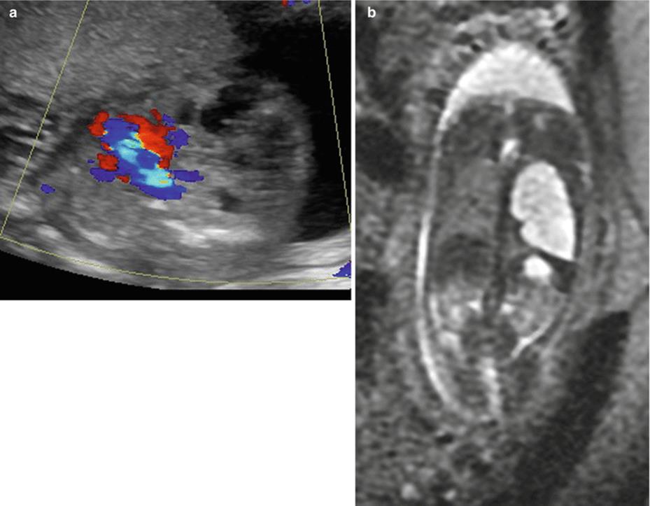 MRI of the Fetal Chest - MRI of Fetal and Maternal Diseases in ...