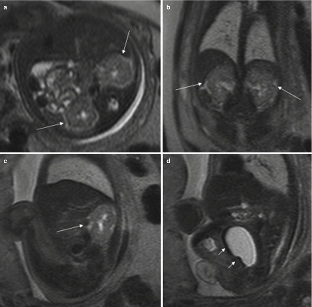 MR of Fetal Abdomen and Pelvis - MRI of Fetal and Maternal Diseases in ...