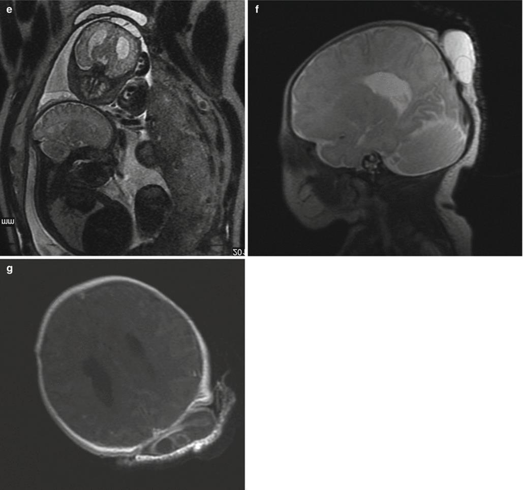 MR Imaging of Multiple Gestations - MRI of Fetal and Maternal Diseases ...