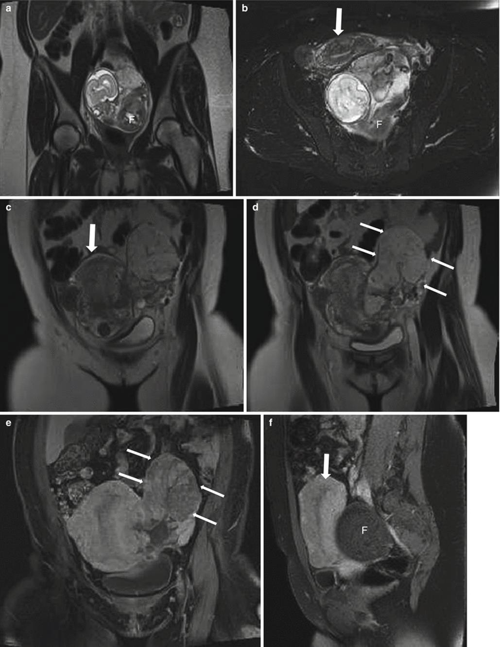 MRI of the Placenta - MRI of Fetal and Maternal Diseases in Pregnancy ...