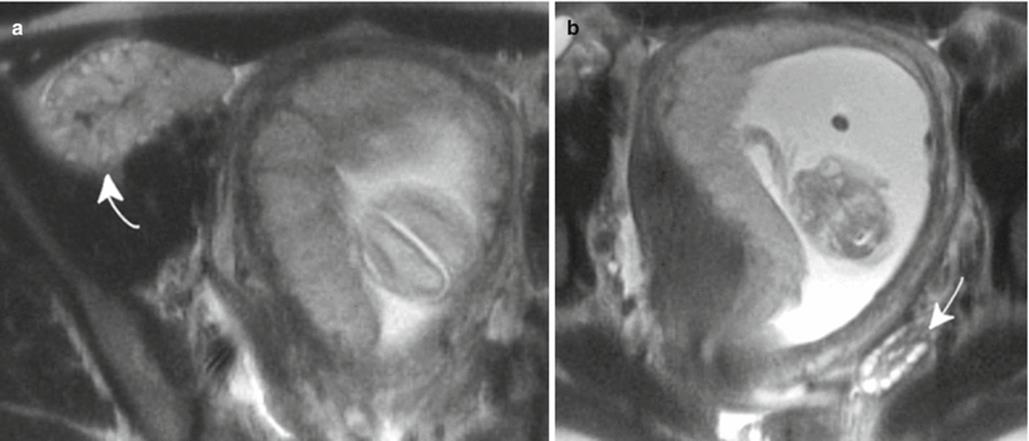 Magnetic Resonance Imaging of Acute Abdominal and Pelvic Pain in ...