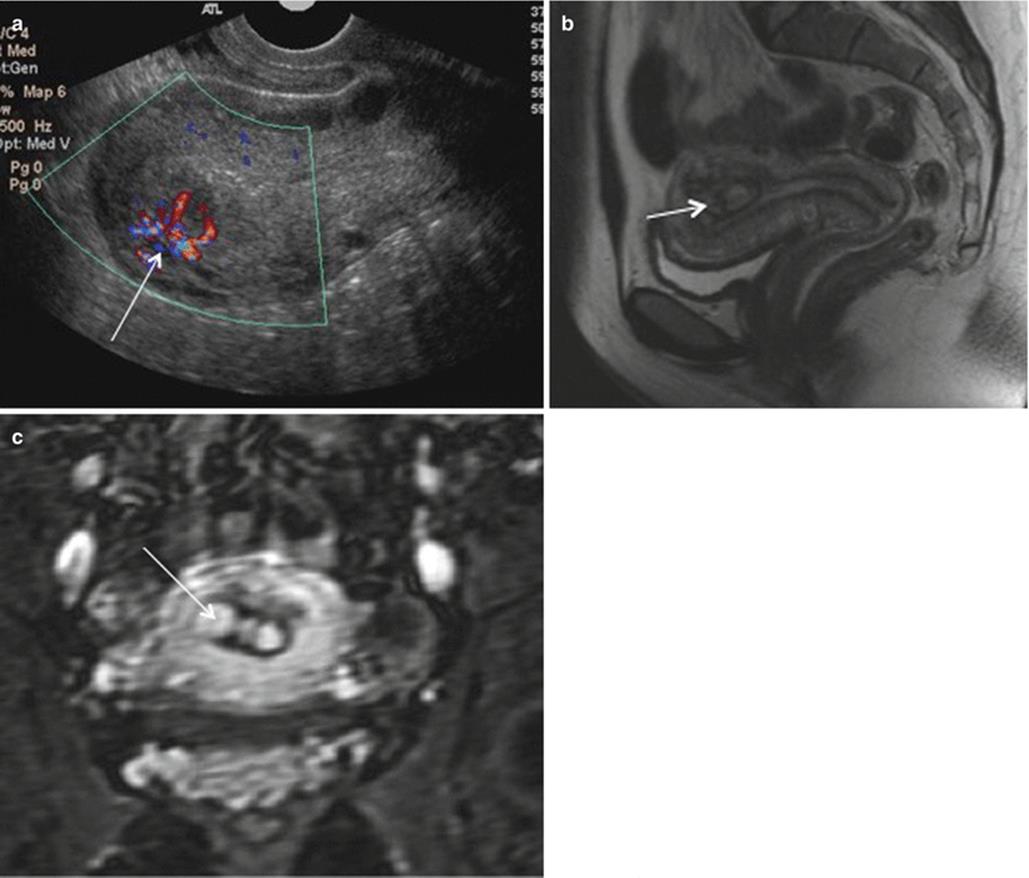 MR of Obstetric Diseases in Pregnancy - MRI of Fetal and Maternal ...