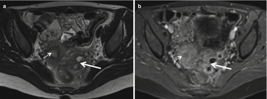 MR of Obstetric Diseases in Pregnancy - MRI of Fetal and Maternal ...