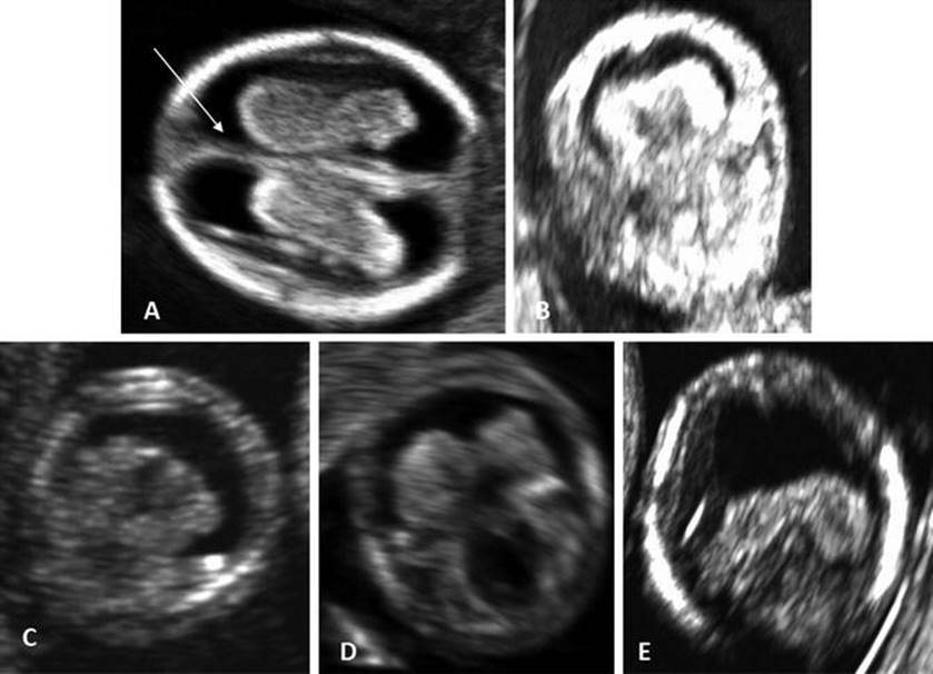 Fetal Anomalies - First-Trimester Ultrasound: A Comprehensive Guide