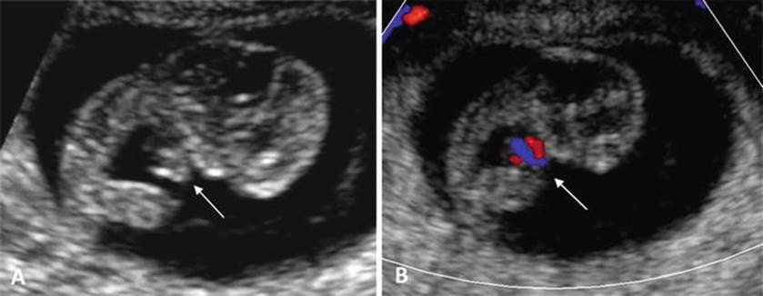 Fetal Anomalies - First-Trimester Ultrasound: A Comprehensive Guide