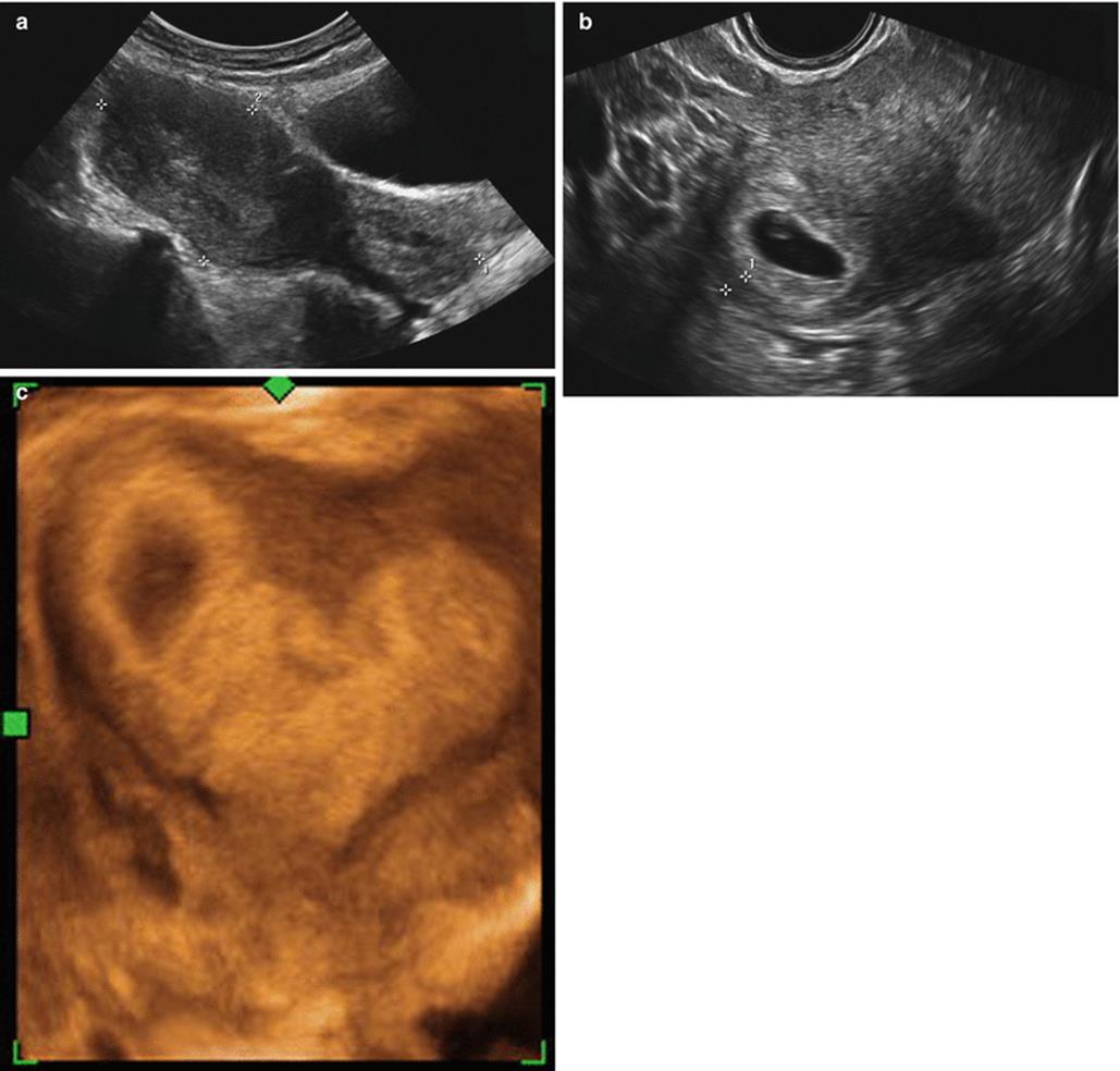 Non-tubal Ectopic Pregnancies: Diagnosis and Management - Management ...