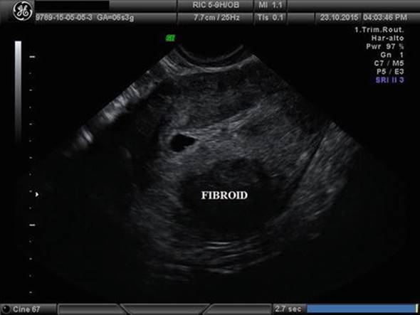 Fibroid Complications in Pregnancy - Management and Therapy of Early ...