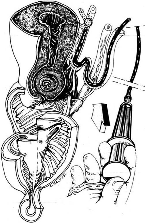 Cervical Pregnancy - Management and Therapy of Early Pregnancy ...