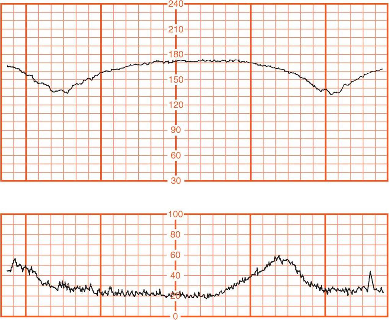 Intrapartum Fetal Heart Rate Assessment - OBSTETRICAL COMPLICATIONS DUE ...
