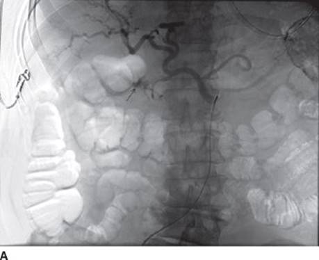 Bleeding Duodenal Ulcer - Clinical Scenarios in Surgery: Decision ...