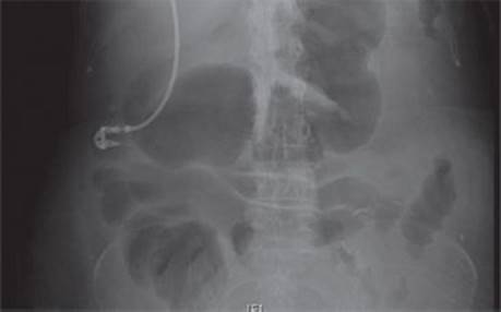 Fulminant Clostridium difficile Colitis - Clinical Scenarios in Surgery ...