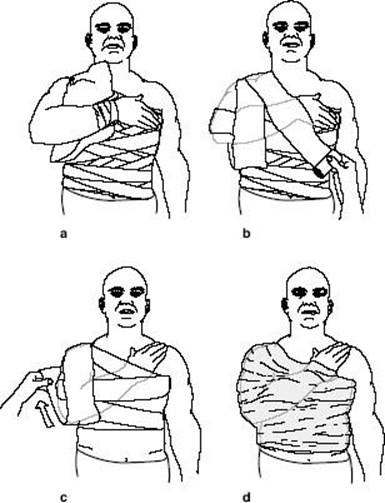 Extremity Fractures - Emergency War Surgery: The Survivalist's Medical ...