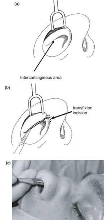 Rhinoplasty Surgery - Fundamentals Of Orthognathic Surgery, 2nd Ed.
