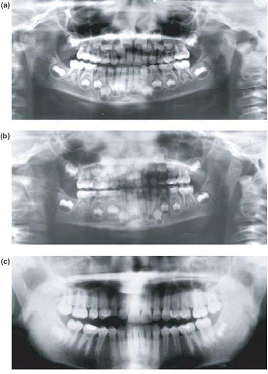 Ankylosis of the Temporomandibular Joint - Fundamentals Of Orthognathic ...