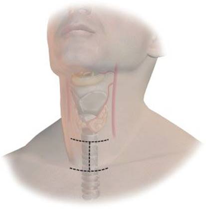 Staged Reconstruction of the Cervical Trachea - RECONSTRUCTION OF THE ...