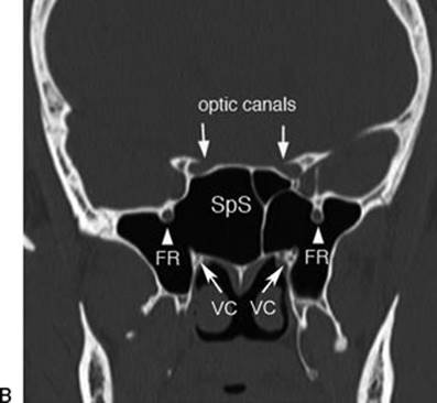 Transpterygoid Approach to the Lateral Recess of the Sphenoid Sinus ...
