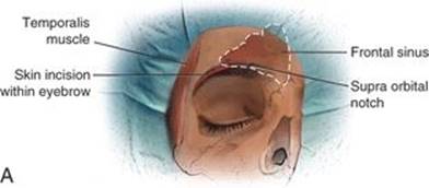 Supraorbital Keyhole Approach to the Anterior Cranial Fossa - ANTERIOR ...