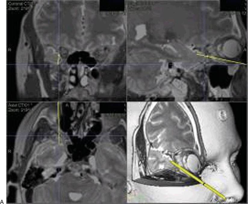 Transorbital Endoscopic Approaches to the Middle Cranial Fossa - MIDDLE ...