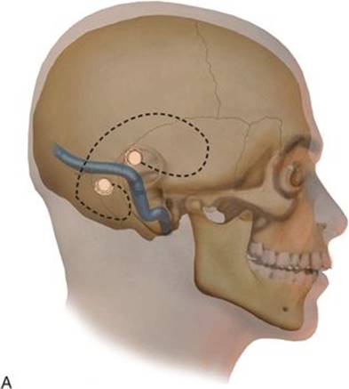 Combined Supra- and Infratentorial Presigmoid Retrolabyrinthine ...
